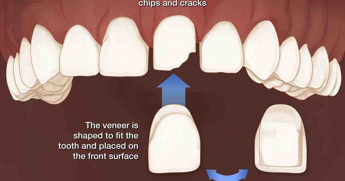Do veneers stay white? - Dental News Network