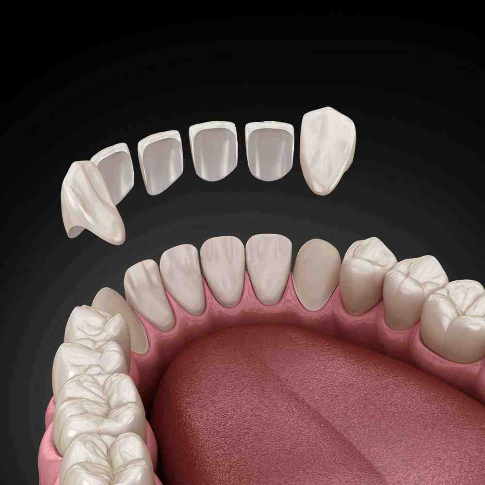 Do veneers last forever? - Dental News Network