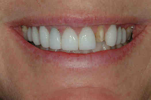 What happens to teeth under veneers? - Dental News Network