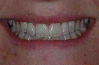 What is a flipper tooth? - Dental News Network