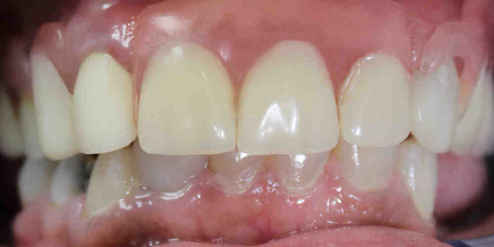 Can a dental implant be shaven - Dental News Network