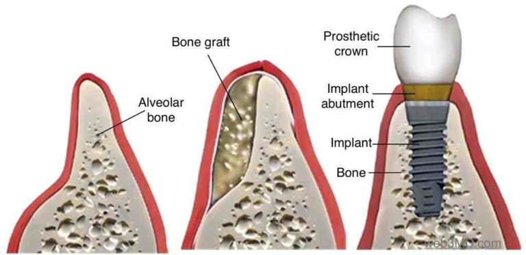 Bone graft for a dental implant? - Dental News Network
