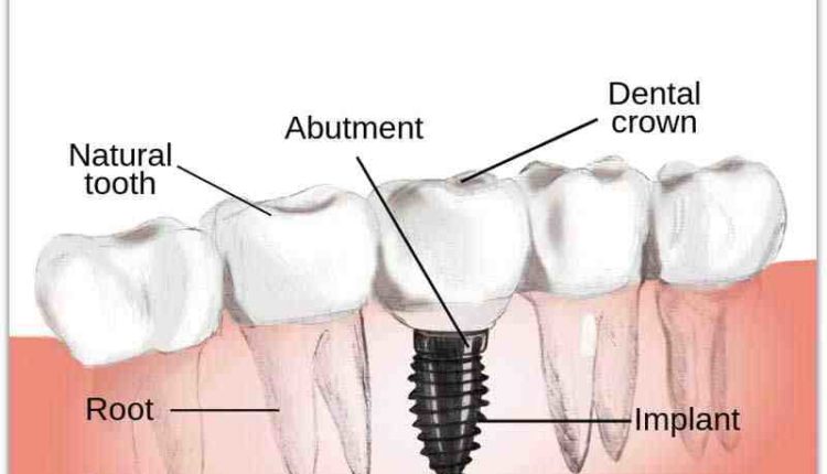 How much does temple dental charge for implants - Dental News Network
