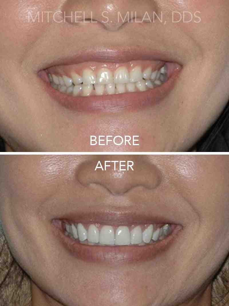 Small teeth cosmetic dentistry - Dental News Network