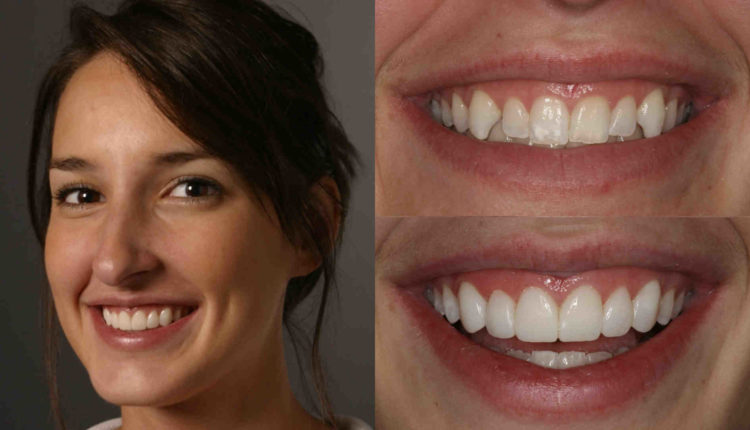 Small teeth cosmetic dentistry - Dental News Network