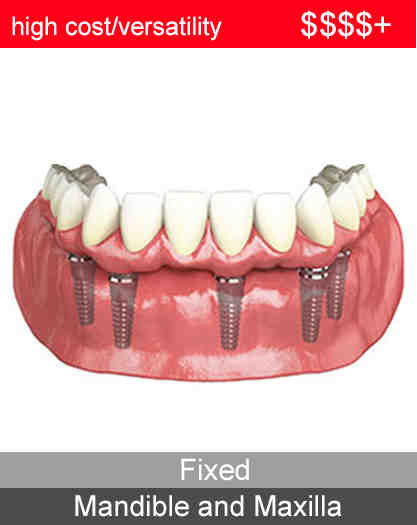 How much would a full arch of dental implants cost at a dental school ...