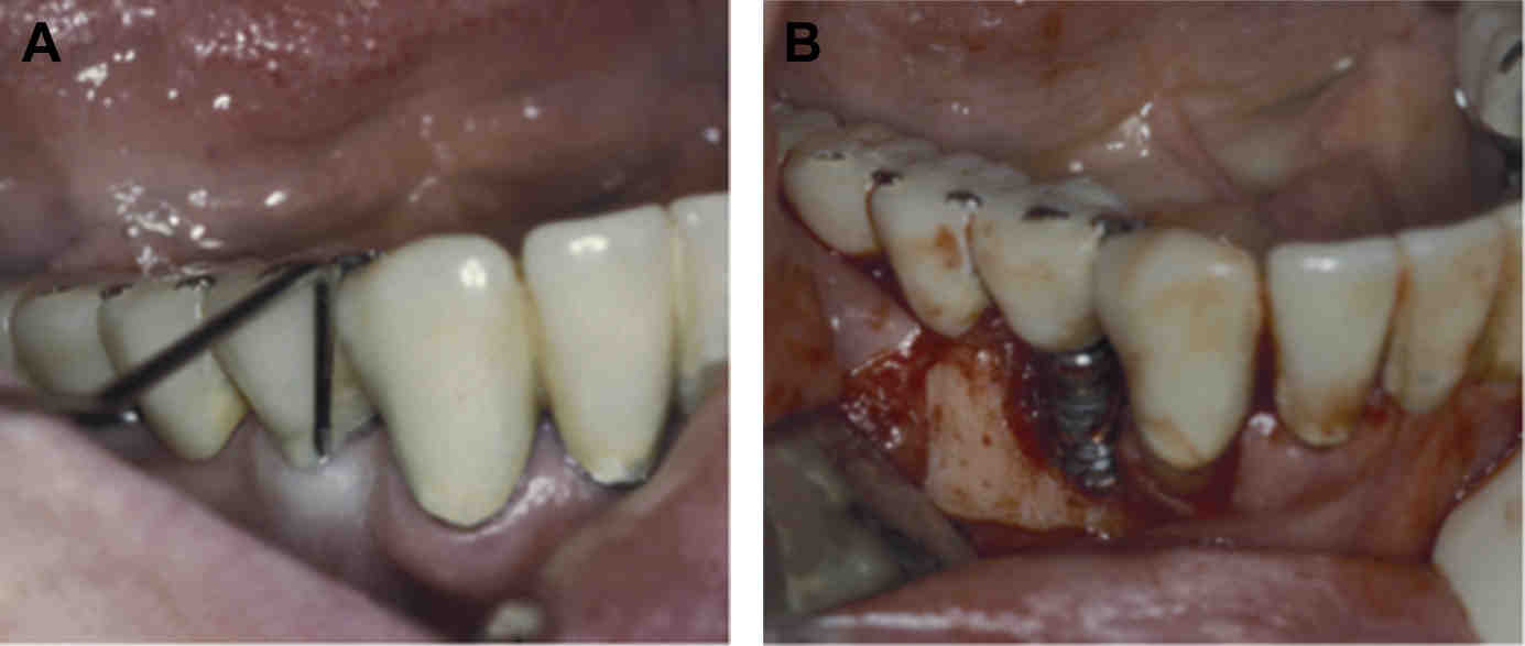 Can levaquin be used for dental implant surgical work - Dental News Network