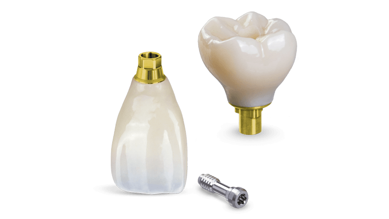 How to cove screw access holes on dental implant crown - Dental News ...