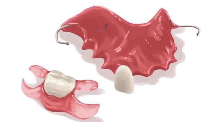 What is a flipper tooth? - Dental News Network