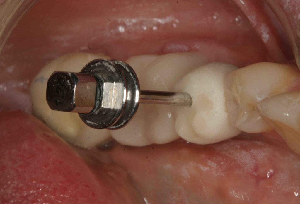 How to cove screw access holes on dental implant crown - Dental News ...