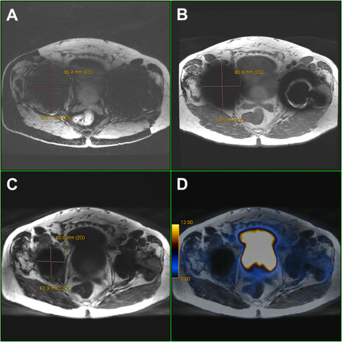 Can you have an mri or pet scan if you have dental implants - Dental ...