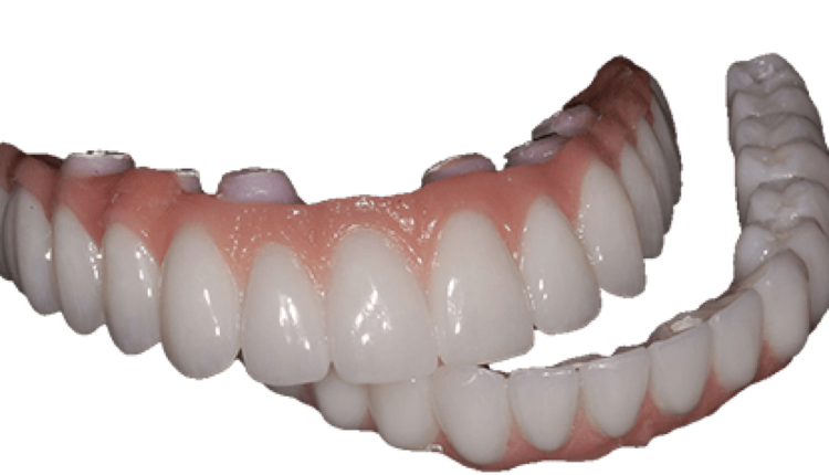 What to do when full top dental implants start coming off - Dental News ...