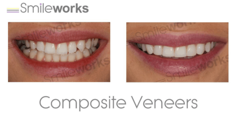 How much is a full set of veneers? - Dental News Network
