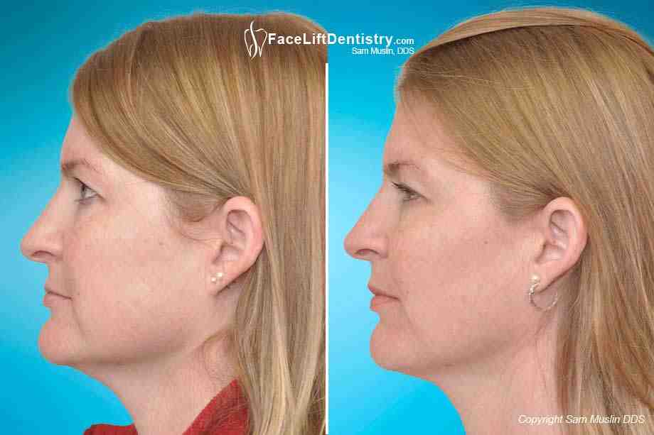 Can dental implants reverse face colapse - Dental News Network