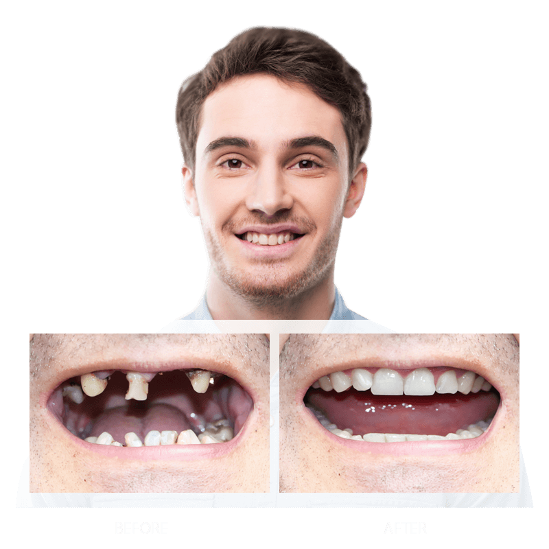 How deep should a dental implant be placed - Dental News Network