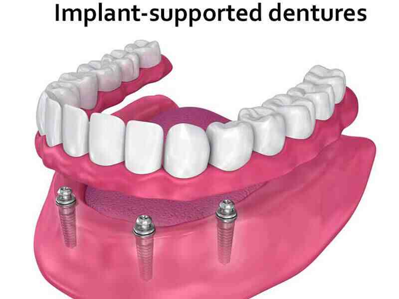 Can a person have dental implants after wearing dentures for 55 years ...
