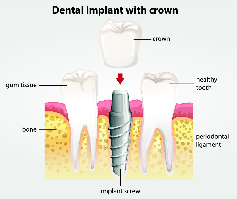 What happens if you dont get a crown? - Dental News Network