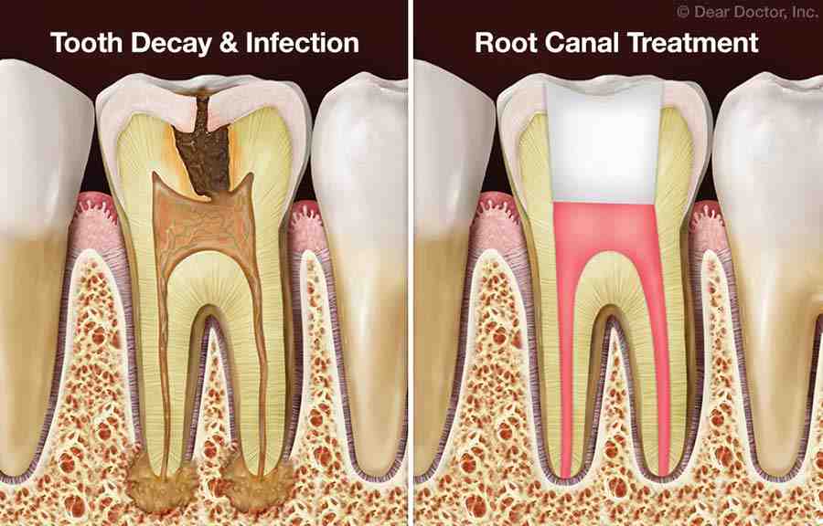 Can A Tooth Decay After Root Canal Dental News Network Can A Tooth Decay After Root Canal Dental News Network