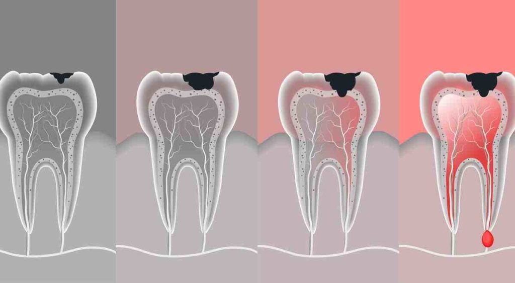 Why are root canals painful? - Dental News Network