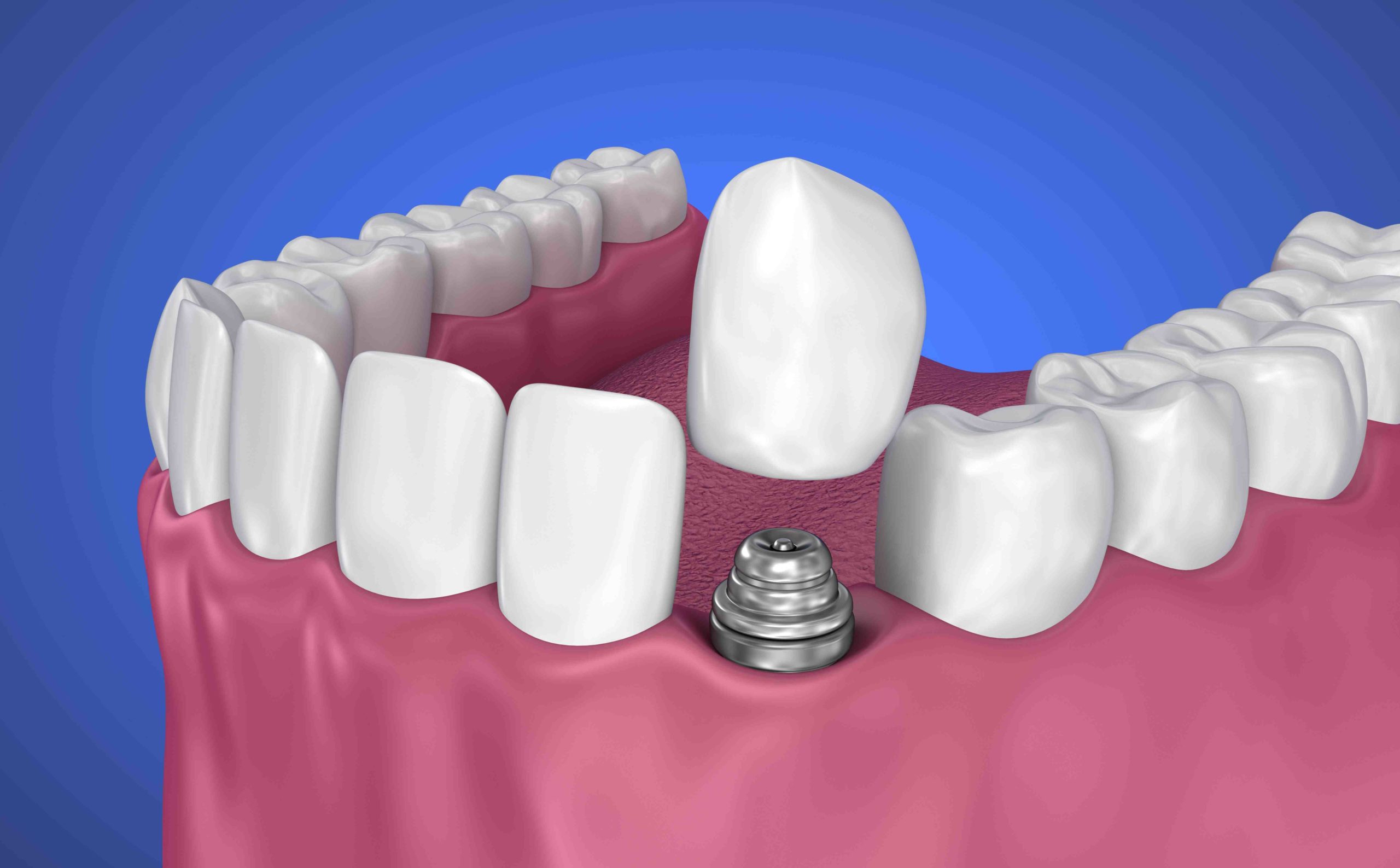 Are there health risks associated with the metal used in dental ...