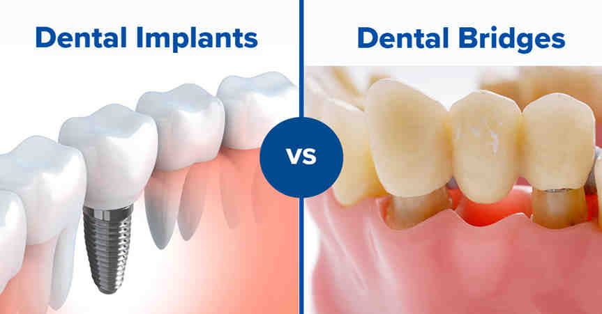 How many dental procedures are there involved in getting implants ...