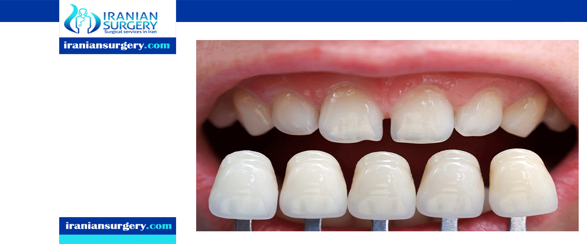 What are the pros and cons of veneers? - Dental News Network