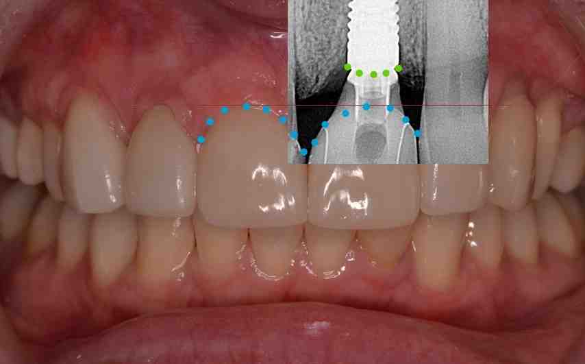How deep should a dental implant be placed - Dental News Network